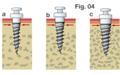 오솔루션 Selection of the orthodontic mini-implant and determination of ...