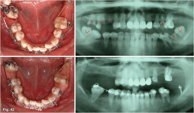 오솔루션 Precautions according to insertion site: Mandible
